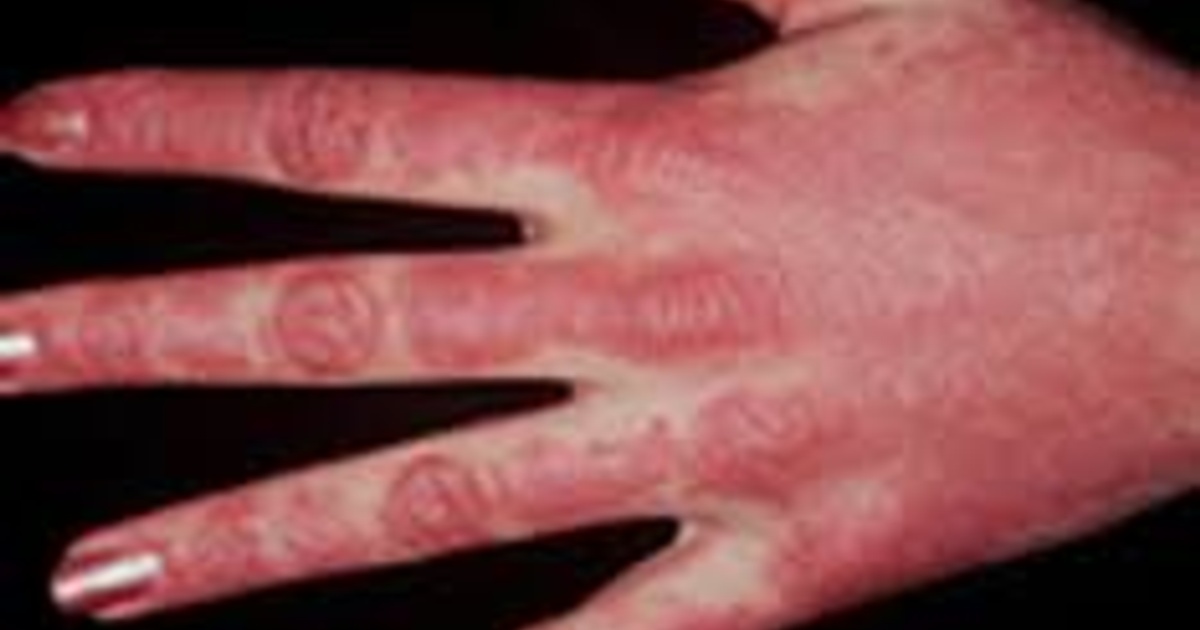 Day 4 #ASKMEABOUTPORPHYRIA #XLP - American Porphyria Foundation